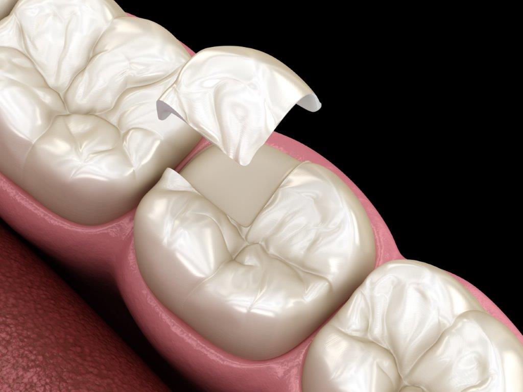 Zahnersatz aus Bad Honnef bei Bonn | Fest & herausnehmbar